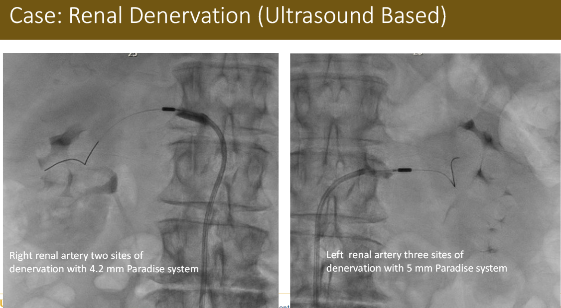 4 Cases: Treating Uncontrolled Hypertension With the Paradise ...